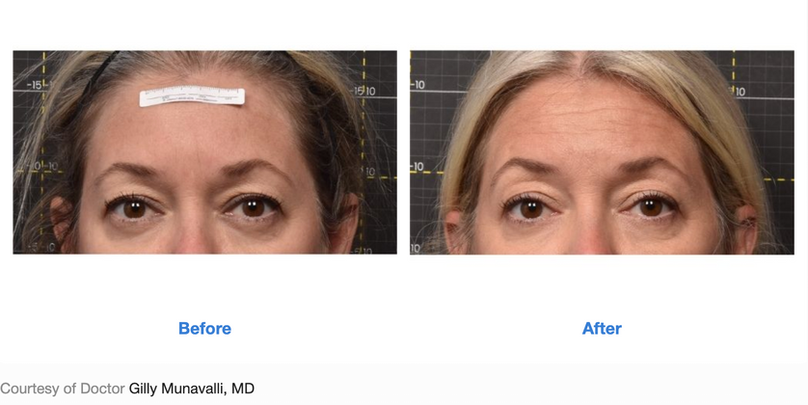 SofWave- Skin Tightening | Peak Image Med Spa