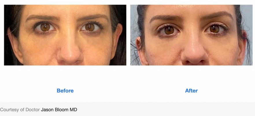 SofWave- Skin Tightening | Peak Image Med Spa