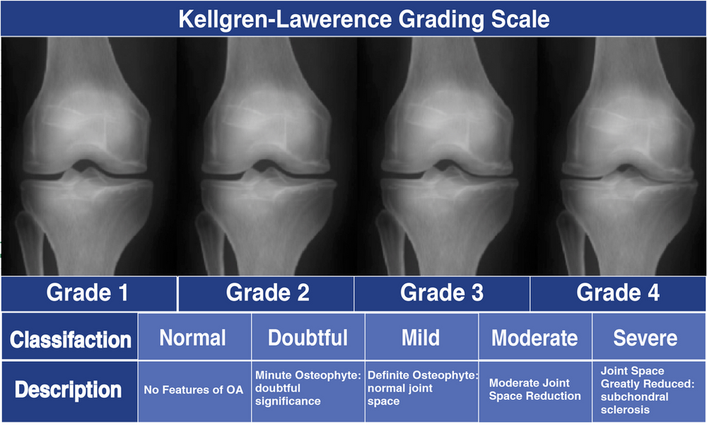 My Knee Is Bone On Bone My Knee Is Bone On Bone
