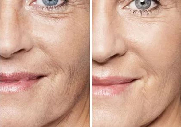 Microneedling Facial (MTS)