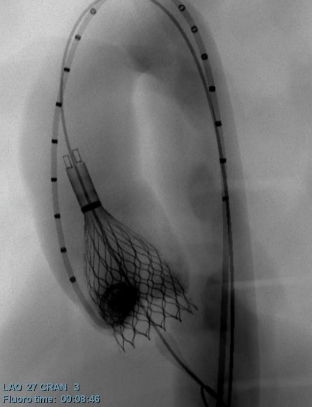 Implante de Válvula Aórtica Transcateter