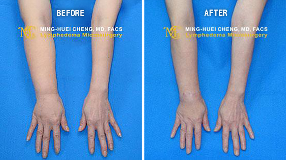 Upper Extremity Lymphedema | 安德森整形外科診所
