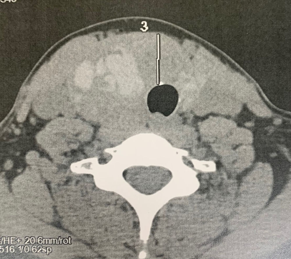 Trans Oral Thyroidectomy Vestibular Anterior (TOETVA)