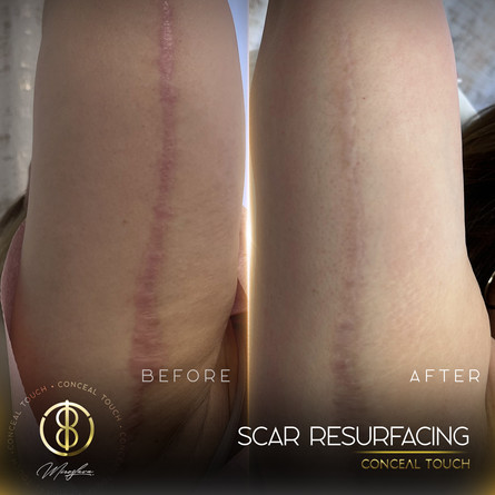 Scar Camouflage Gallery | Conceal Touch | Houston, TX