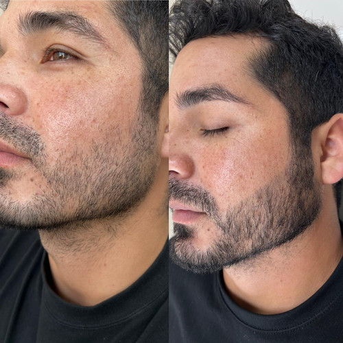 Microblading de barba | Microblading