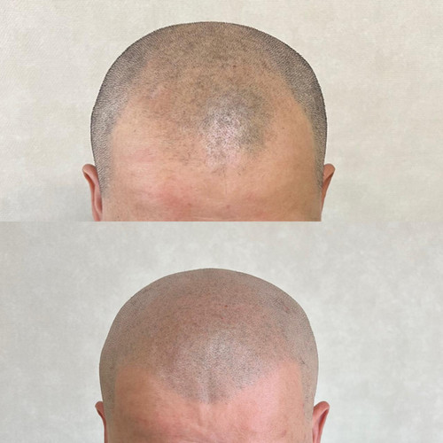 Micropigmentación Capilar | Cuero Cabelludo | Scalp | SMP | Microblading