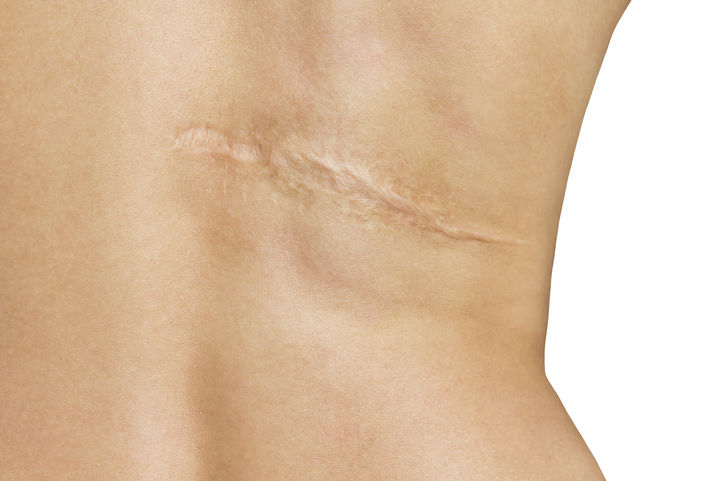 Minimizing Appearance of Scars Naturally!