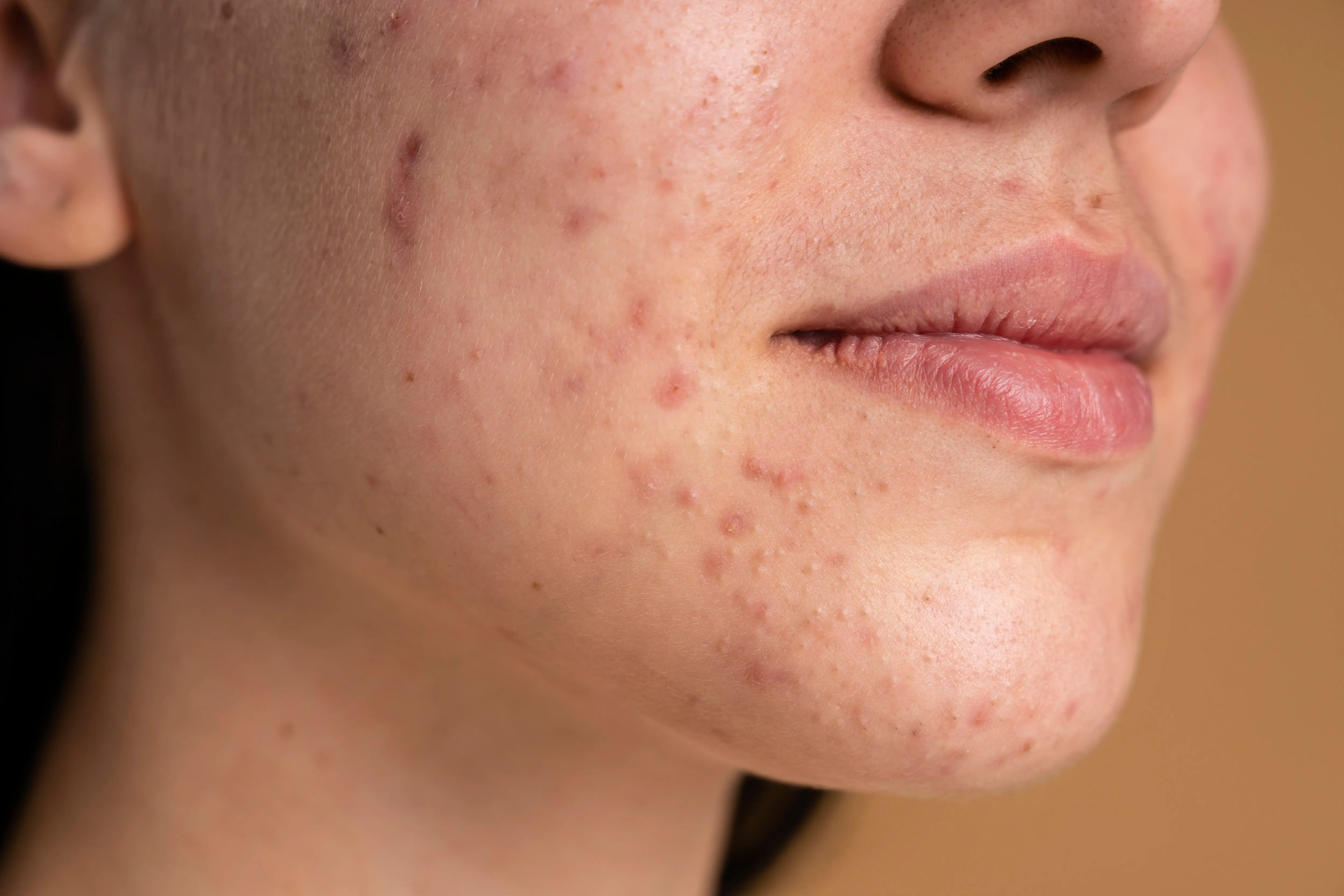 Chin acne: What are the causes and treatments? | KINS Clinic