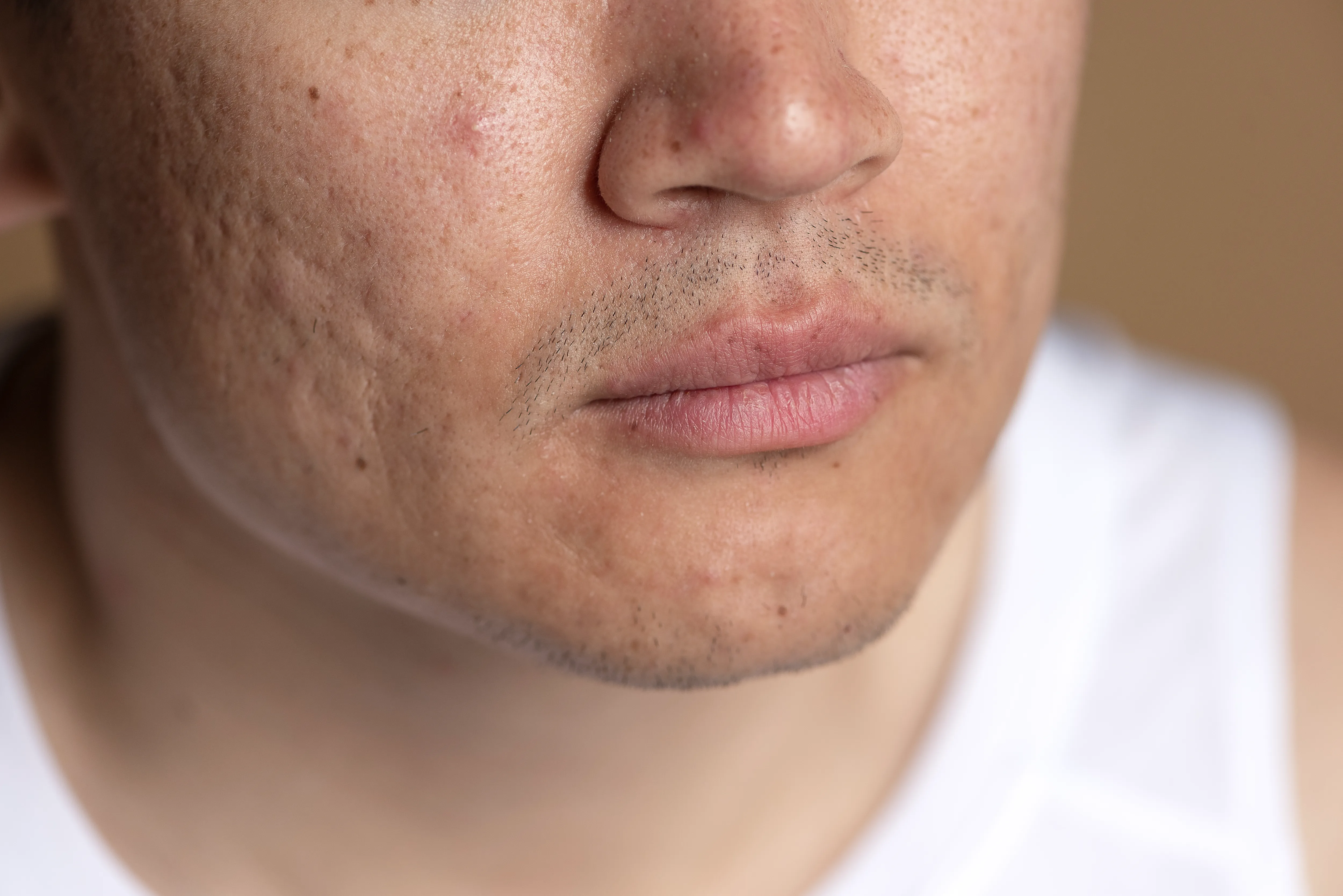 Acne scars: Types and Causes | KINS Clinic