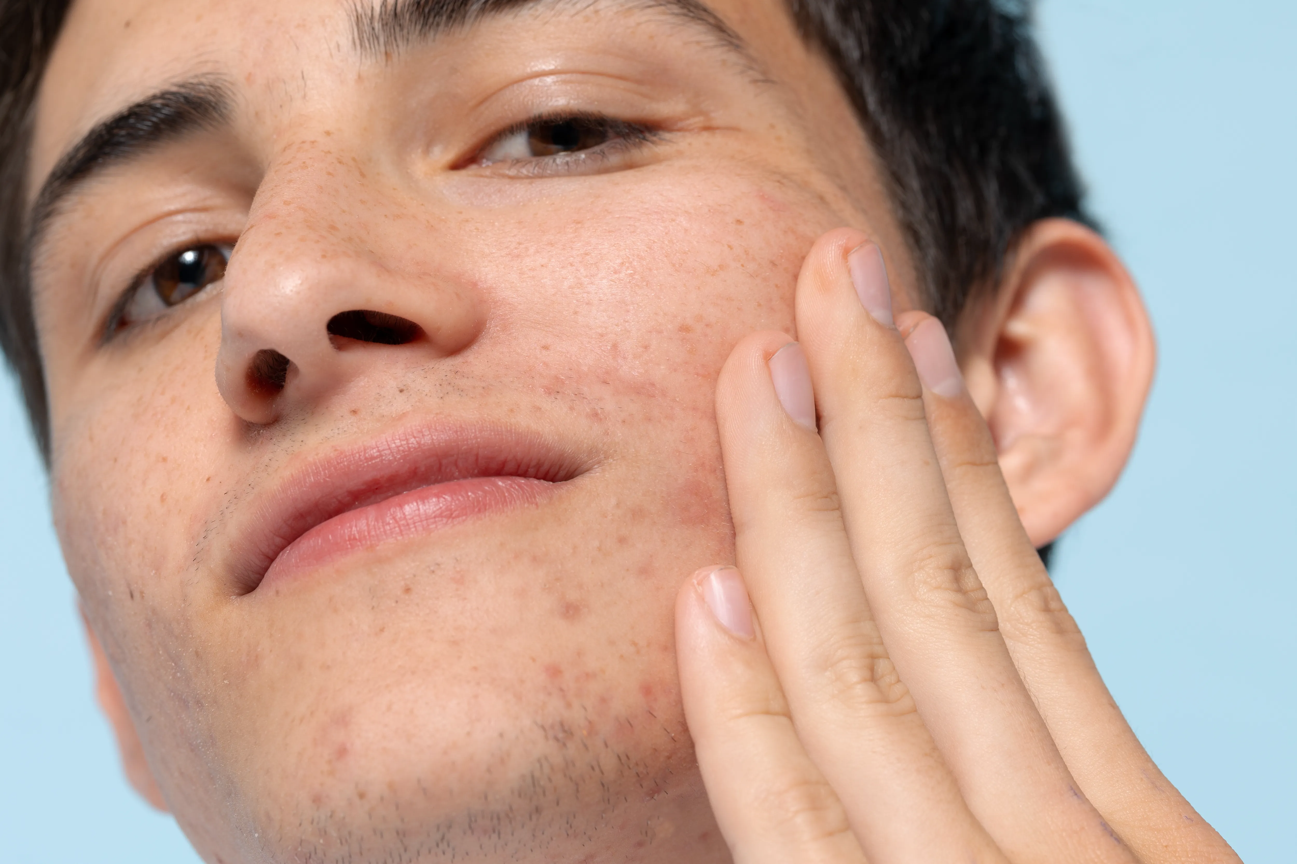 All You Need To Know About Adult Acne | KINS Clinic