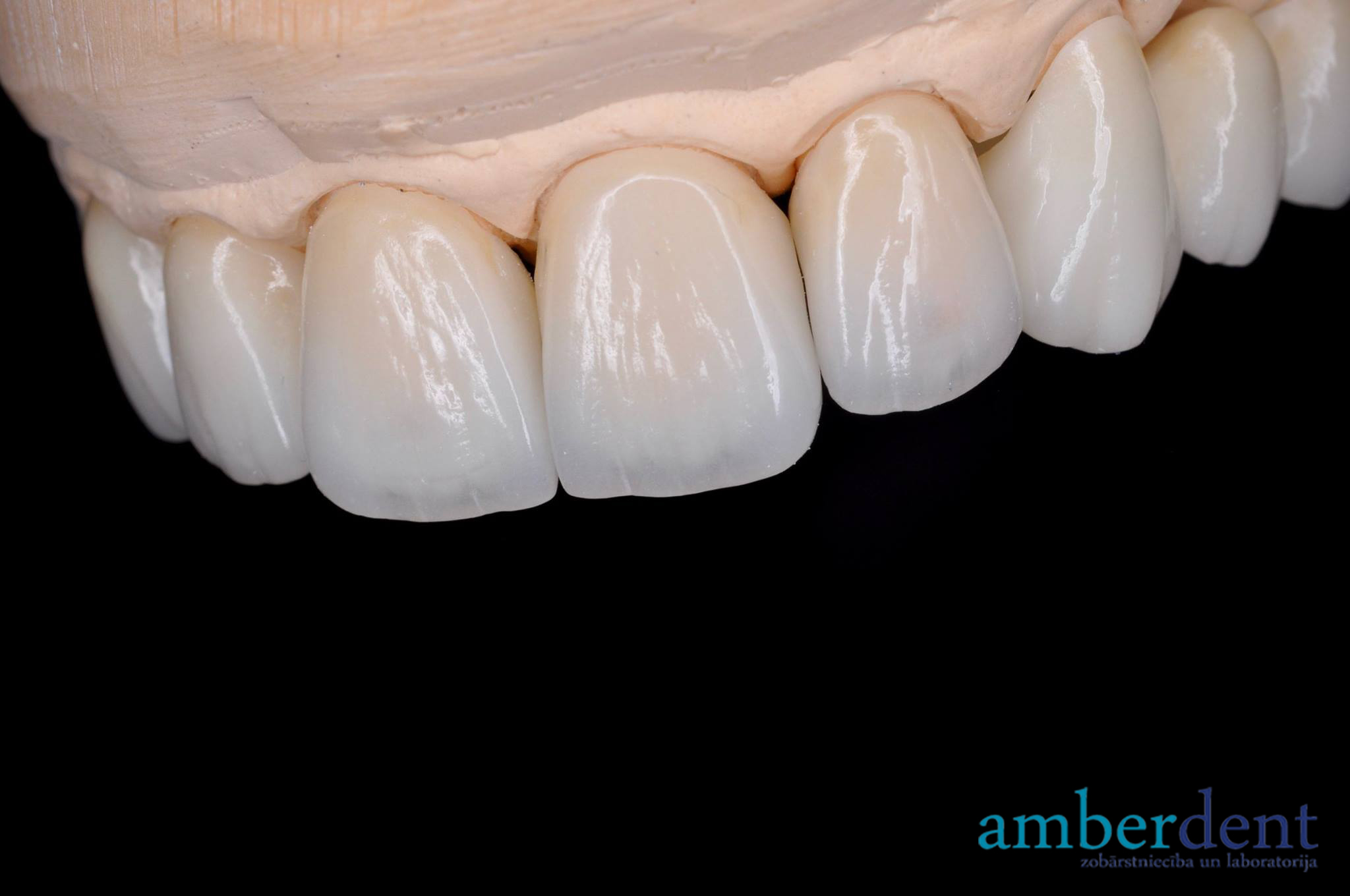 Protezēšana | Venīri | Implanti | Amberdent Clinic Jūrmalā