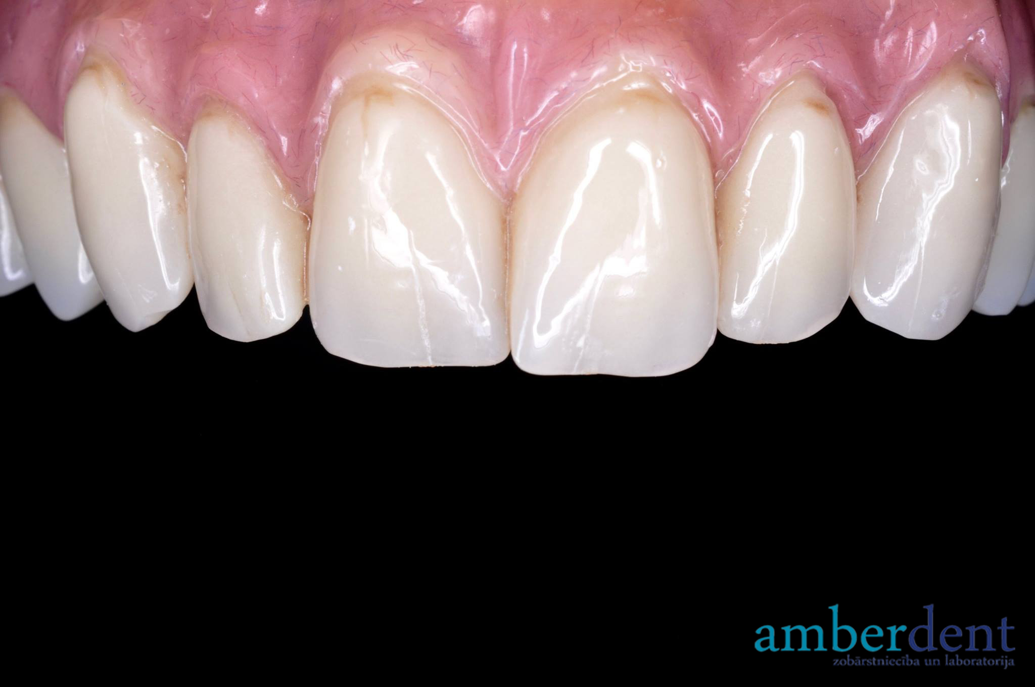 Protezēšana | Venīri | Implanti | Amberdent Clinic Jūrmalā