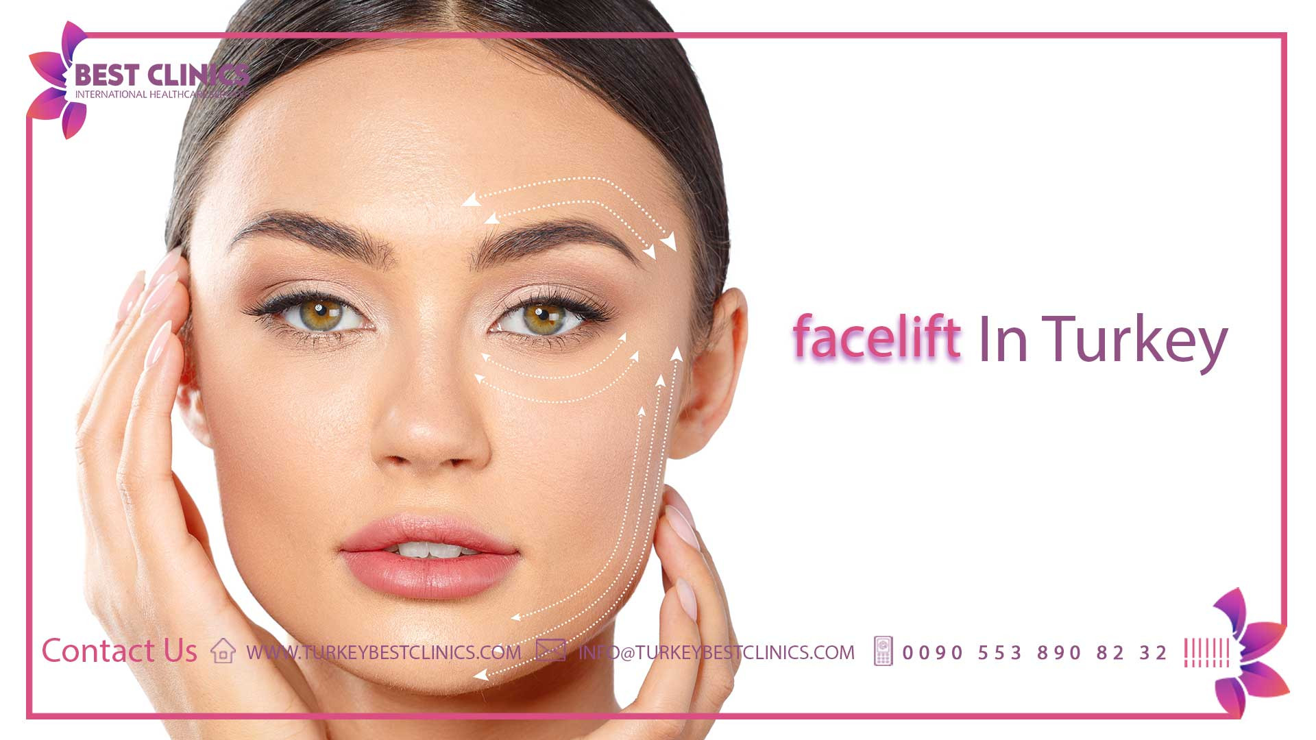 Fox eyes in Turkey - The Full Guide to Fox Eyes and Thread Lift in ...