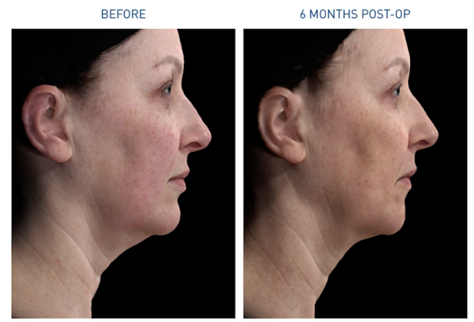 Renuvion J Plasma | RJ CLINIC