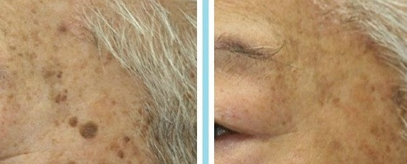 Ageing Brown Spots | Seborrheic Keratosis | RJ Clinic
