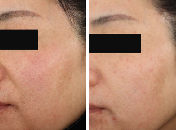 Rejuran Healer: The Revolutionary Skin Rejuvenation Treatment