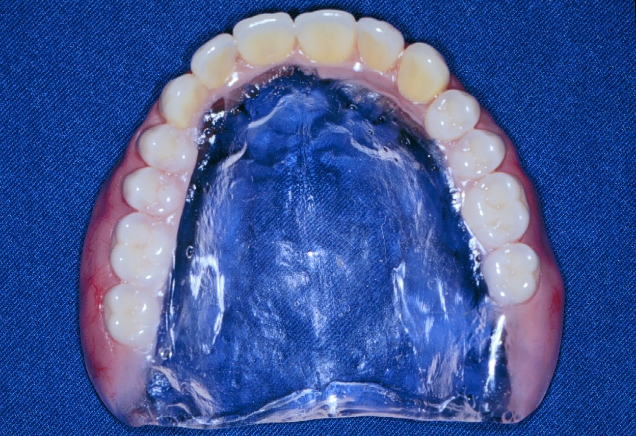 Os cinco mandamentos na prótese total convencional e sobre implantes