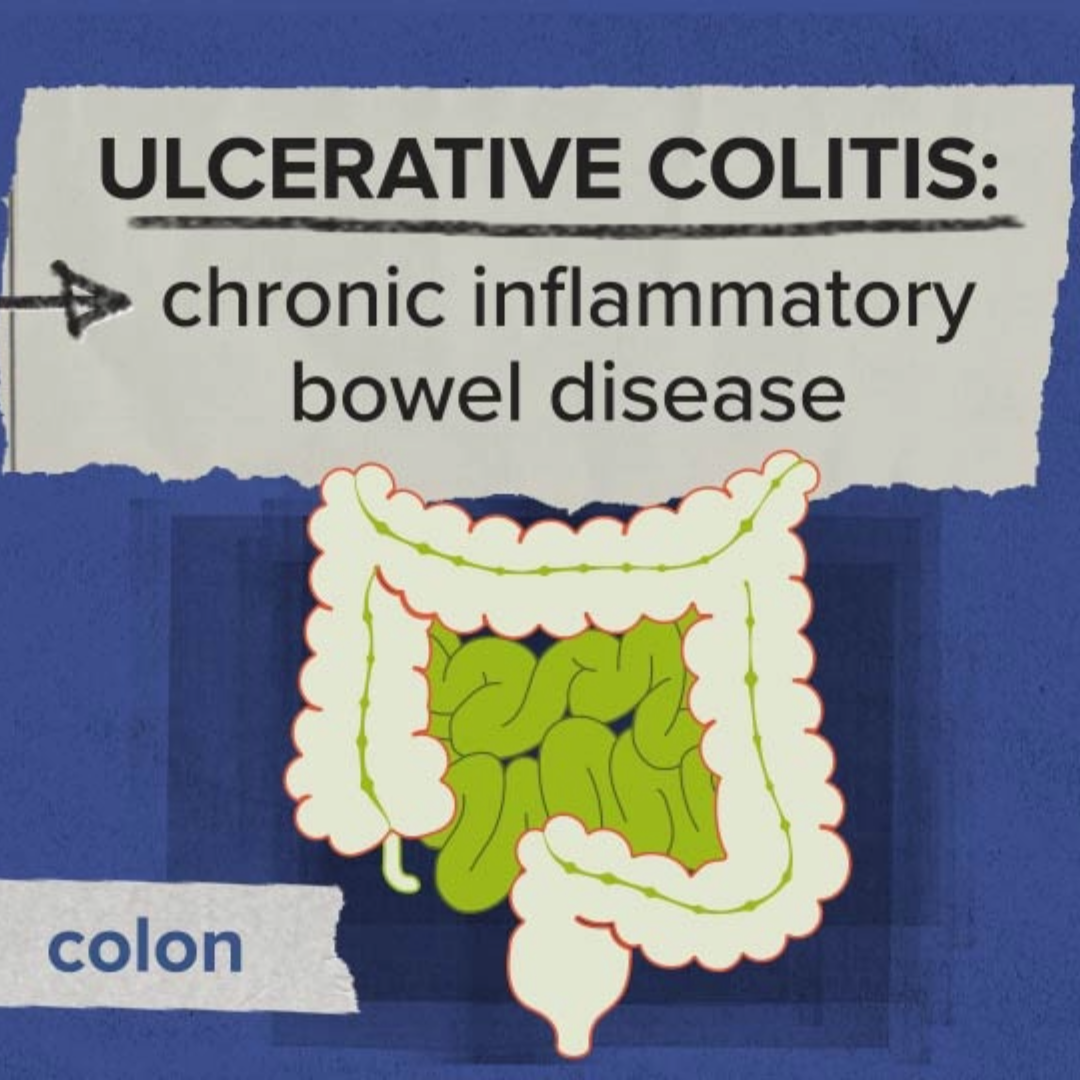 medical-news-today-ulcerative-colitis
