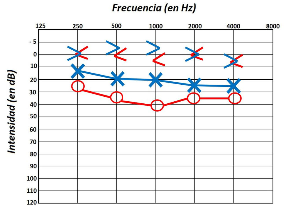 AUDIOMETRÍAS: LO QUE NECESITAS SABER