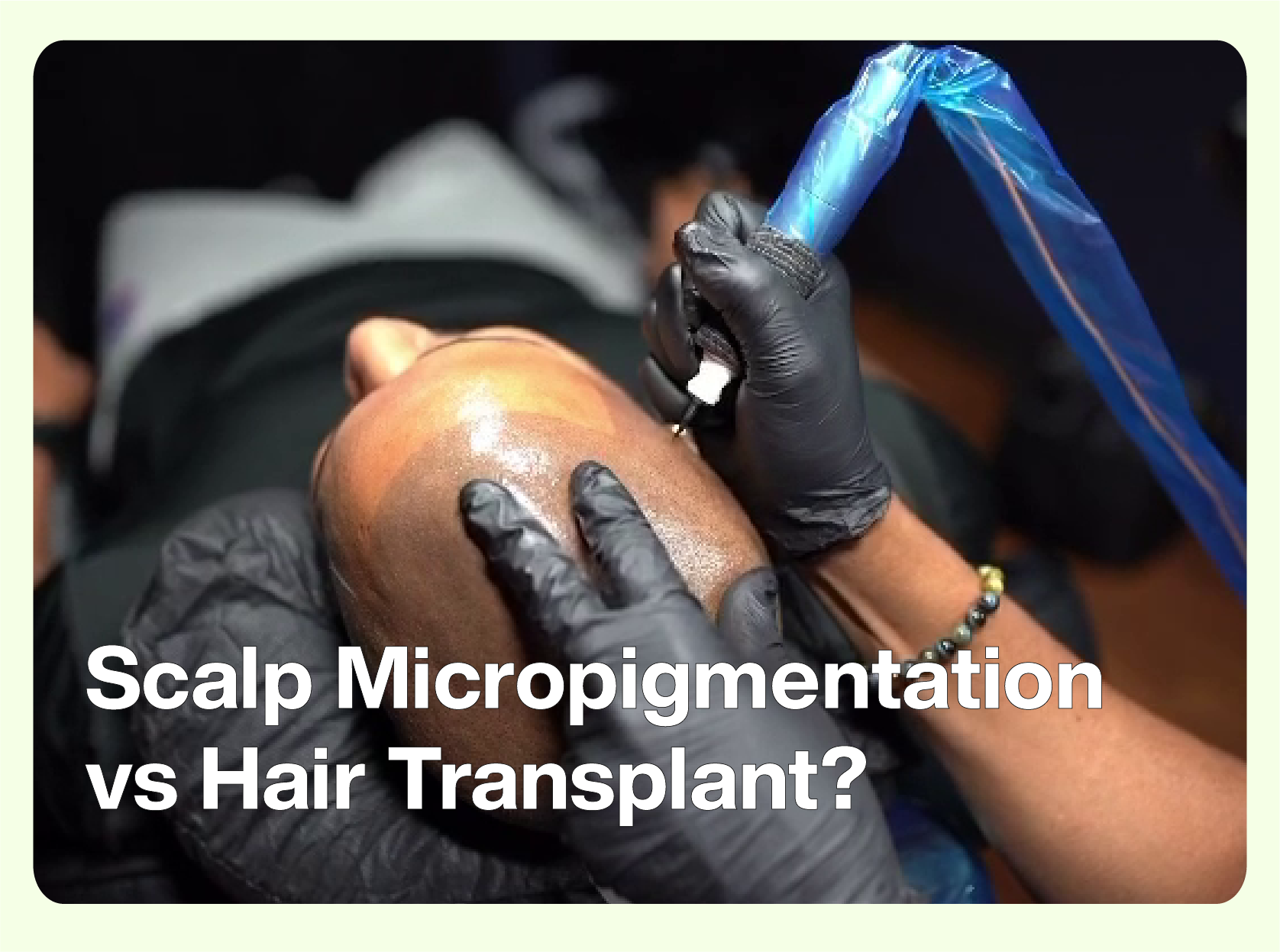 SMP vs. Hair Transplant: Why SMP is the Smarter Choice for Hair Loss ...
