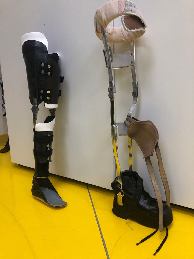 Improved comfort and function for prosthetic and orthotic users with ...