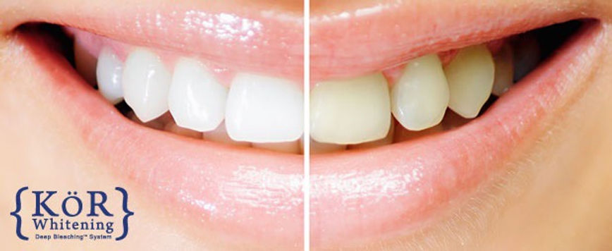 How does Kör Whitening System work?