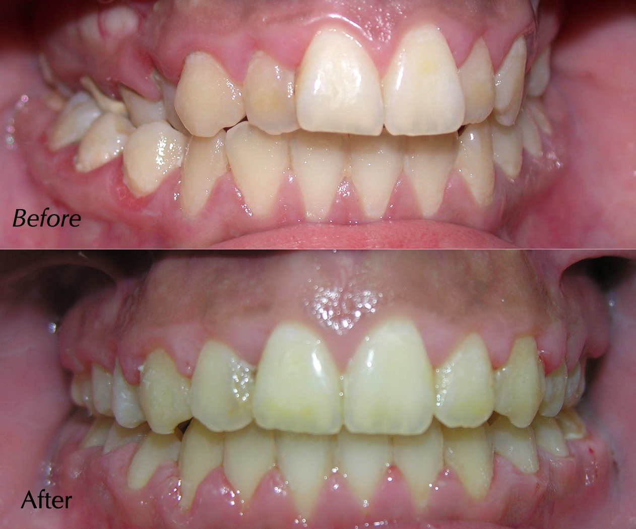 Cross bite | FIRST DENTAL CENTER