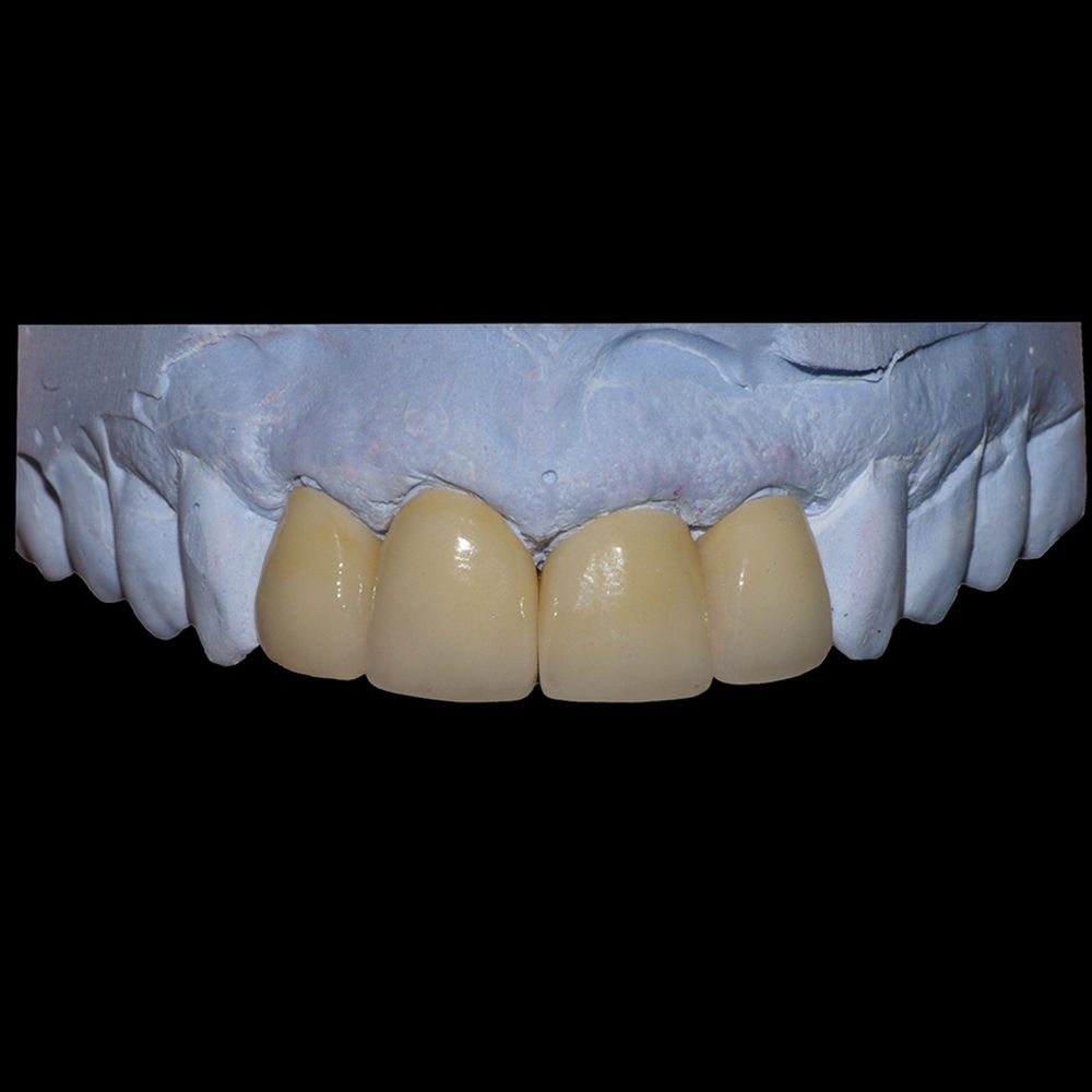 Layered Zirconia