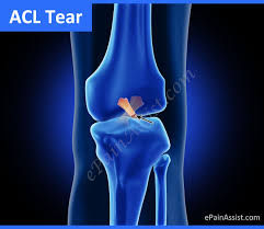 ACL Injuries, What You Need To Know
