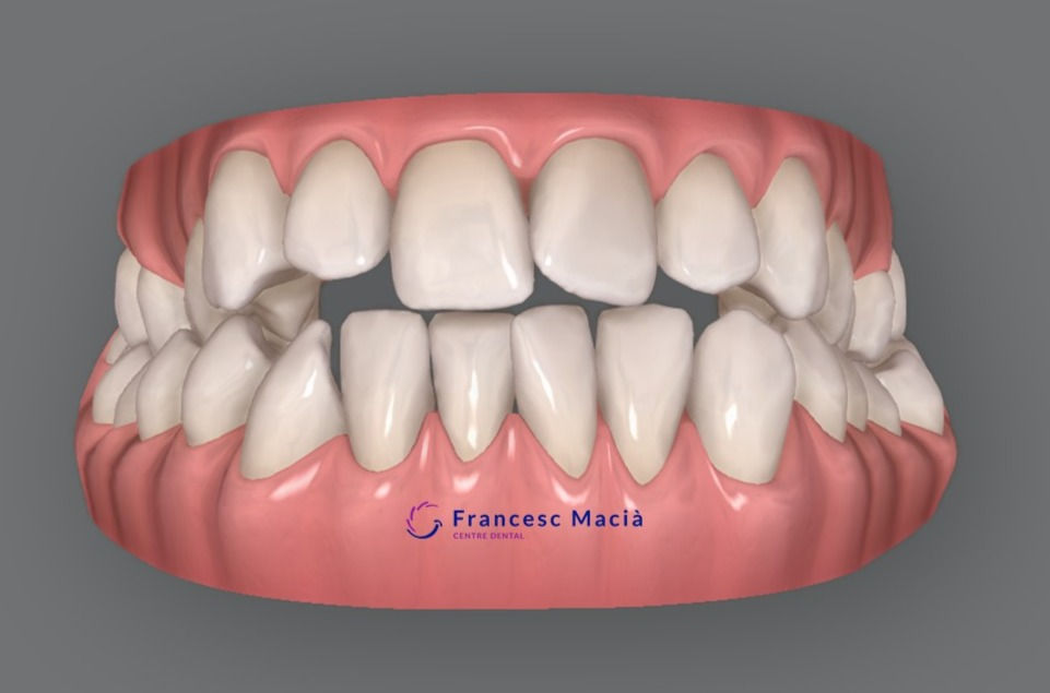 ¿Qué es la sobremordida?