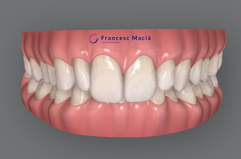 ¿Qué es la sobremordida?
