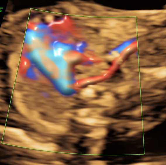 Fetal Echocardiography | FDCAZ