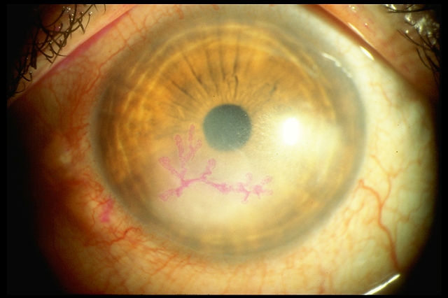 Dendritic Corneal Ulcer
