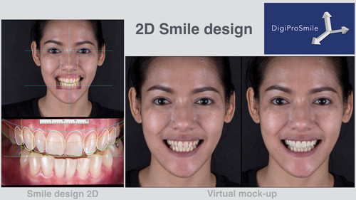 2D Smile design | digiprosmile