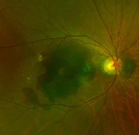 Eye Doctor Paul Zhao | Retina Specialist | Eagle Eye Centre Singapore