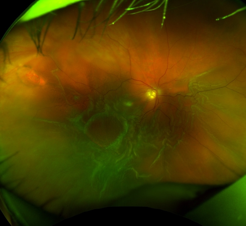 Dr Paul Zhao - Retina Surgery | Retina Specialist in Singapore ...