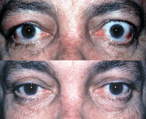 Is it possible to have bulging eyes without gravedisease? : r/gravesdisease