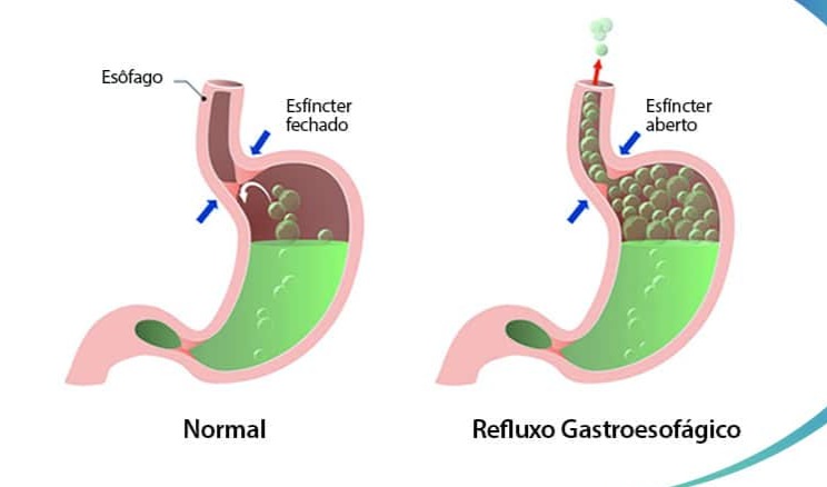 Refluxo gastroesofágico