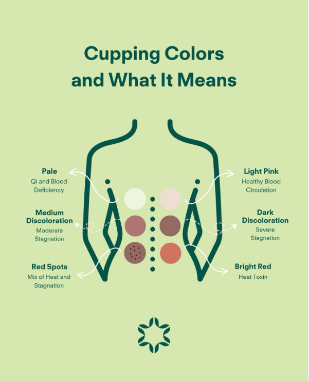 What Do TCM Cupping Marks and Colors Mean?