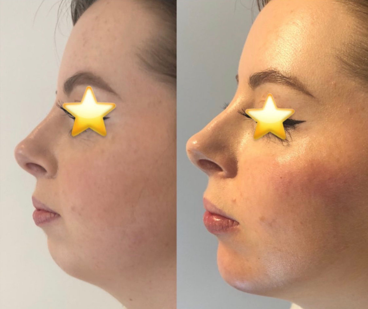 Chin Contouring Enhancements | Butterfly Aesthetics