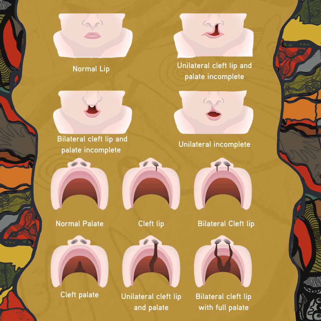 July is National Cleft and Craniofacial Awareness and Prevention Month