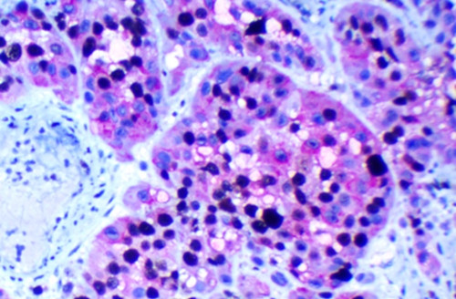 Multiplex IHC control-Melanoma 01 | Springside Sci.
