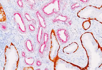 Prostate Cancer panel | Springside Sci.