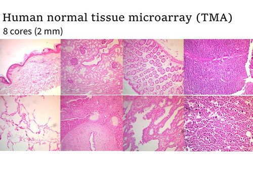 (TMA) 8 Breast cancer tissue | Springside Sci.