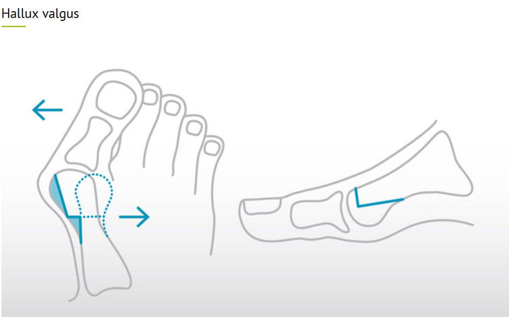Hallux valgus