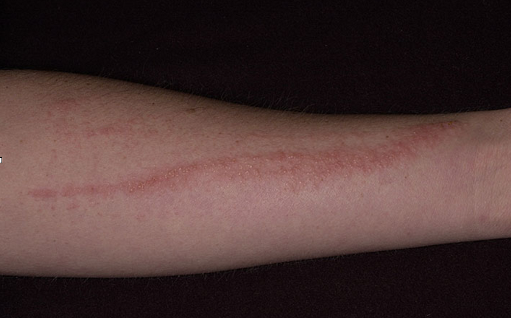 A Gardner's Nightmare: Poison Ivy