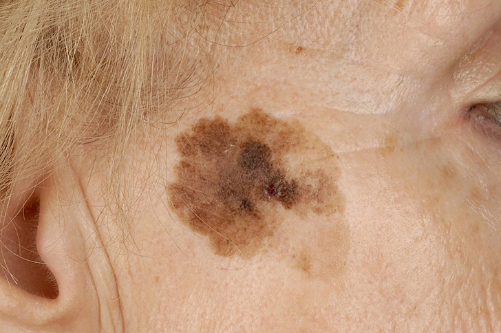 Seborrheic Keratosis Removal in Nottingham | Dr Jenna Wa Skin Surgery