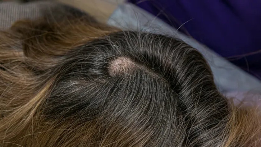 Pilar Cysts: Easy-to-Treat Lumps on the Scalp