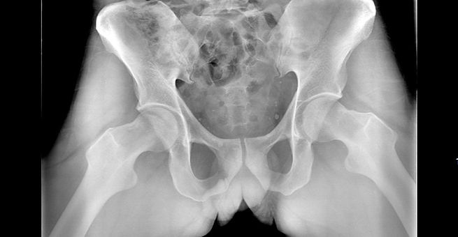 Proyección Dunn 45° | proyecciondunn