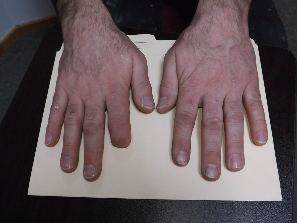 Finger Amputation in North America